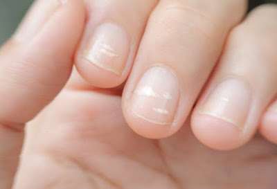 How the white spots on your fingernails can be signs of heart disease ...